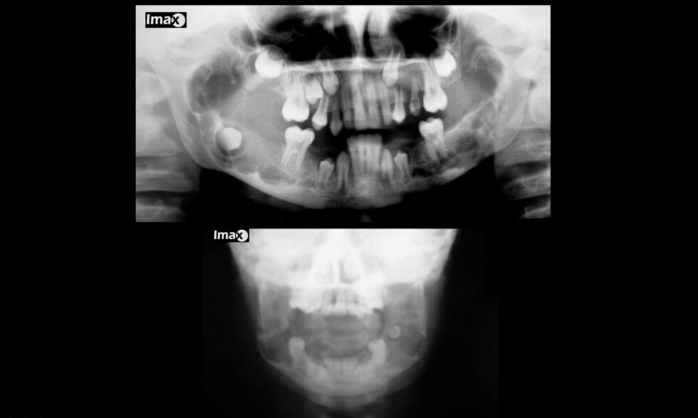 Caso 27 Querubismo. | Imaxradiologia
