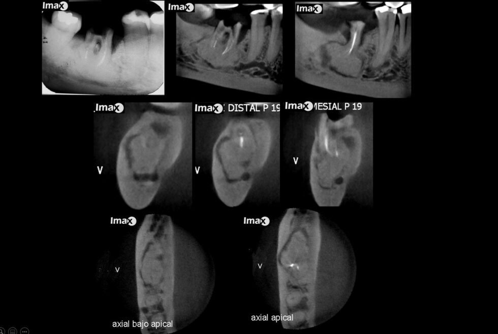 Caso 60 Cementoblastoma benigno asociado al primer molar inferior ...